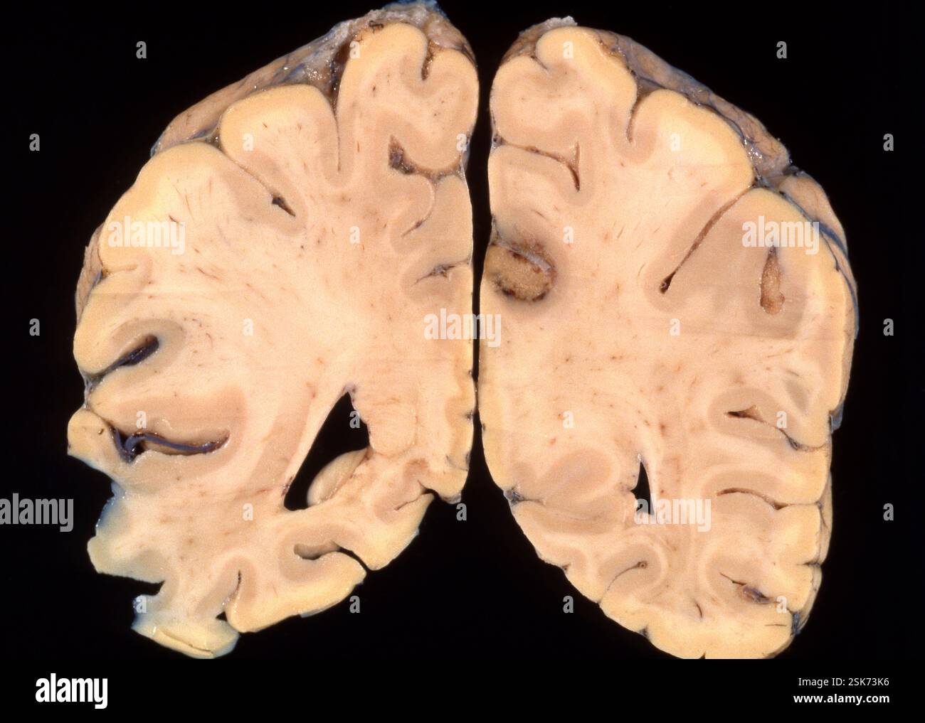 Gross specimen of a section of the brain with a cerebral lymphoma ...