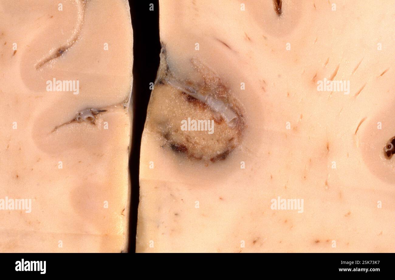 Gross specimen of a section of the brain with a cerebral lymphoma ...