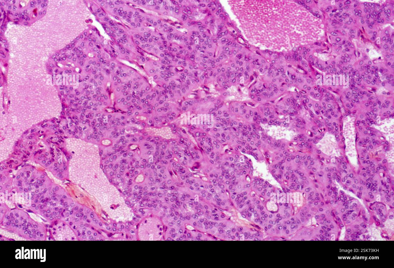 Light micrograph of a cauda equina paraganglioma. A cauda equina ...