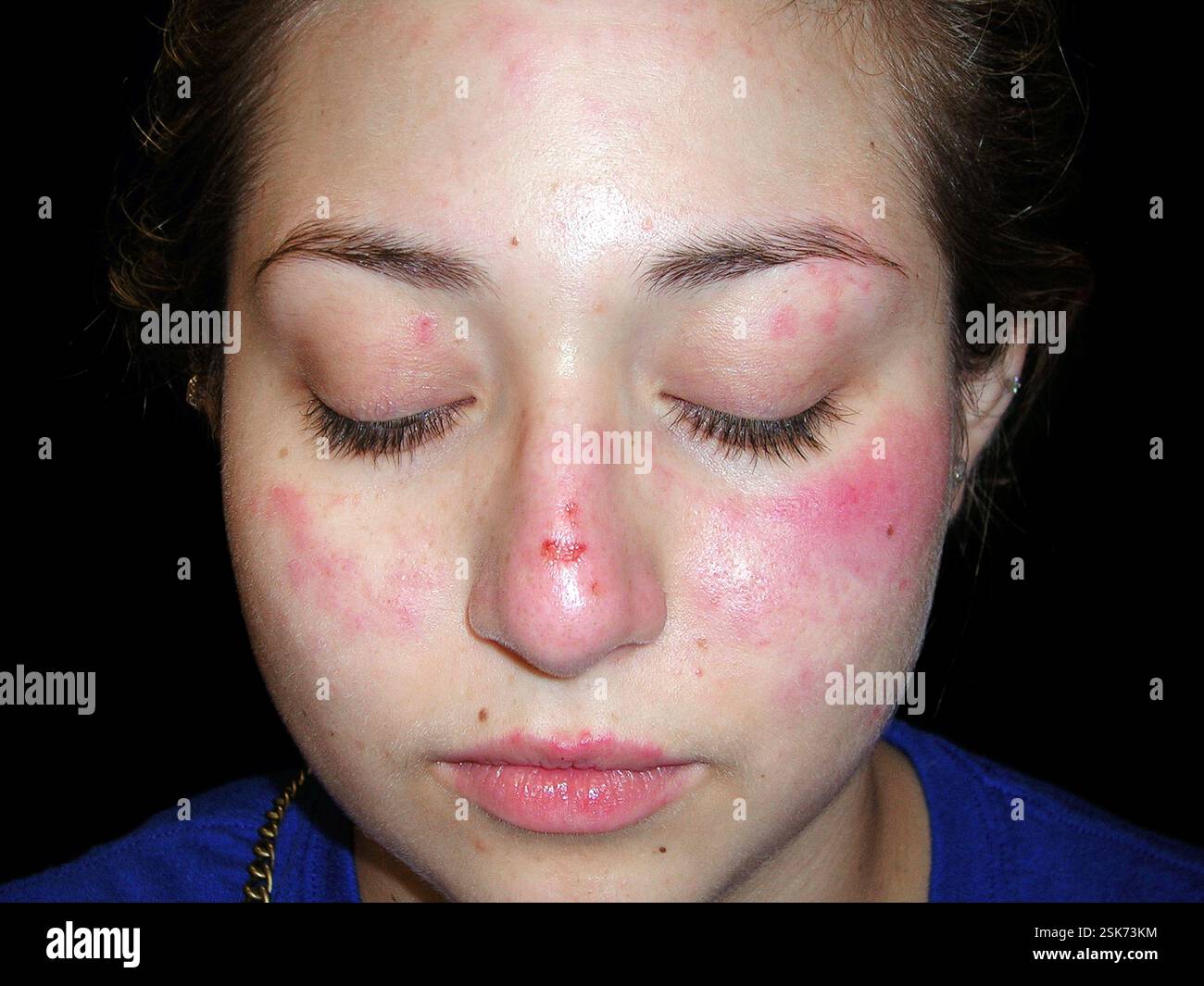 Acute cutaneous lupus rash on the face of a 22 year old female patient ...