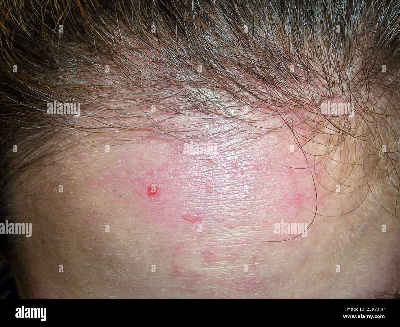 Acute cutaneous lupus rash on the forehead of a 22 year old female ...