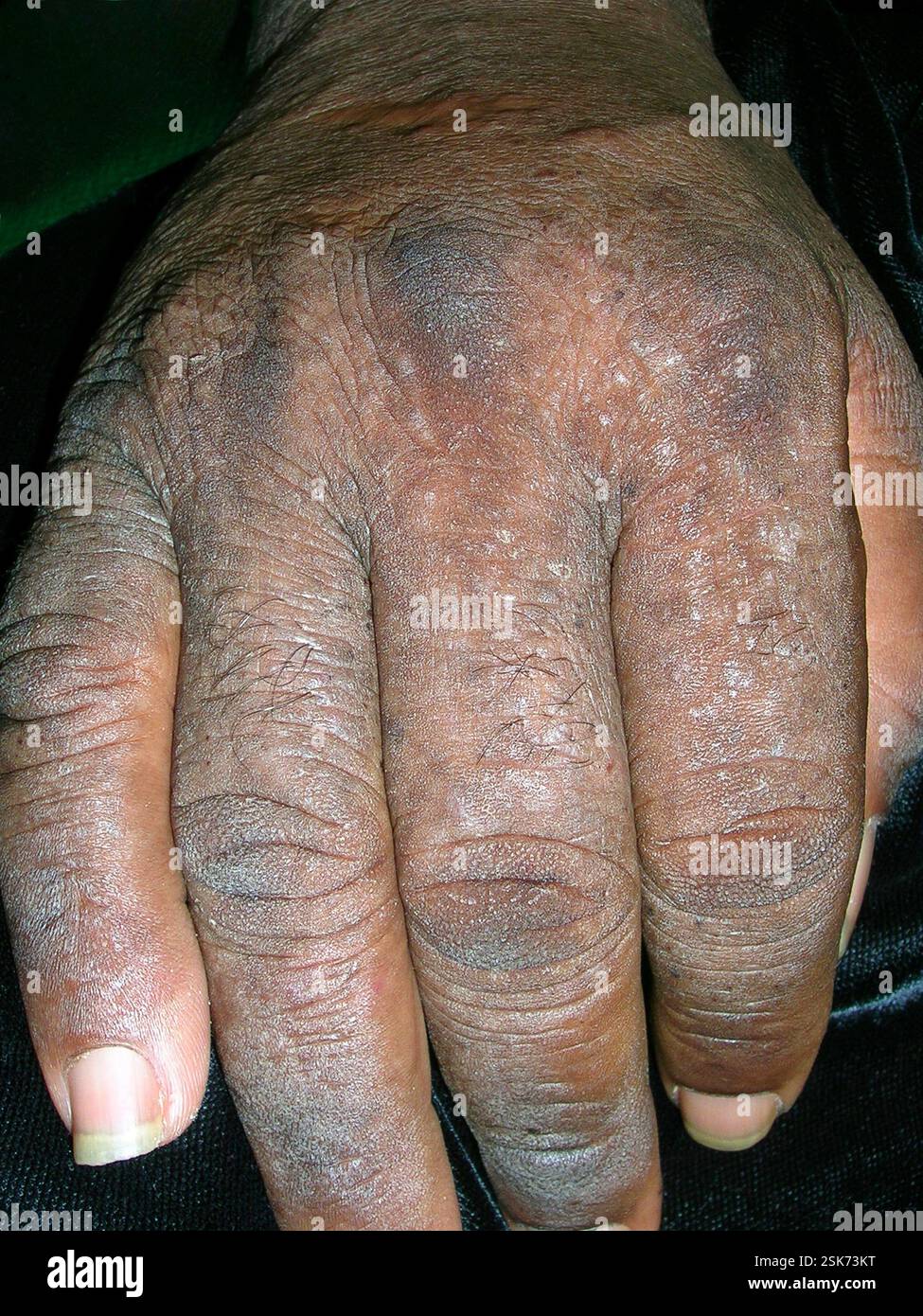 Darkened skin on a patient's fingers in a case of acanthosis nigricans ...