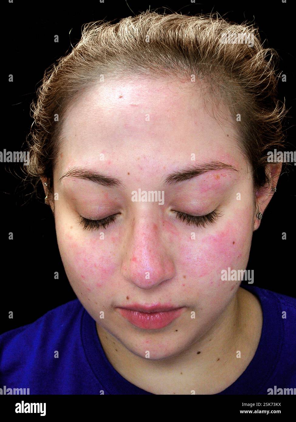 Acute cutaneous lupus rash on the face of a 22 year old female patient ...