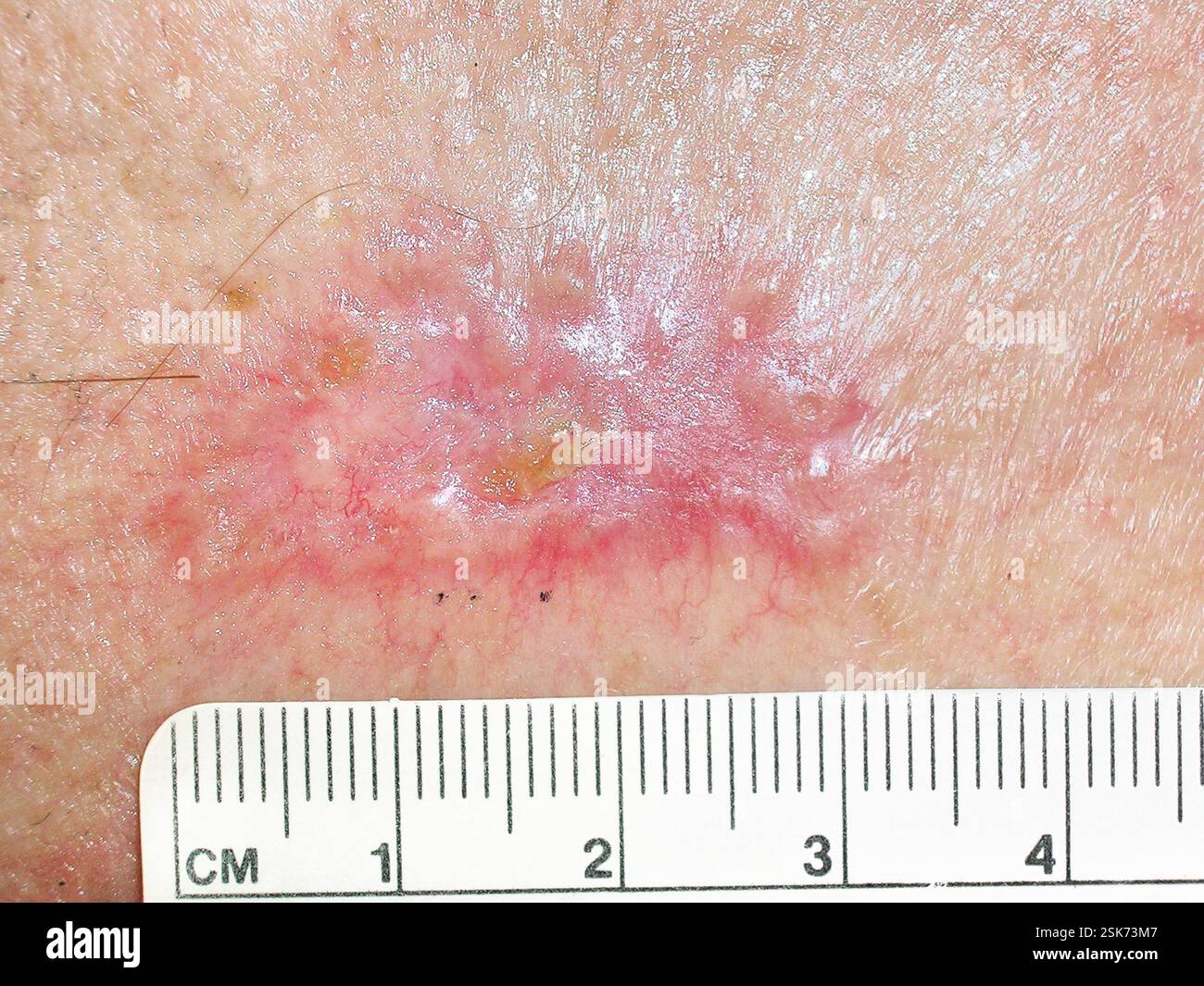 Basal cell carcinoma (BCC), or rodent ulcer, on a patient's chest. This ...