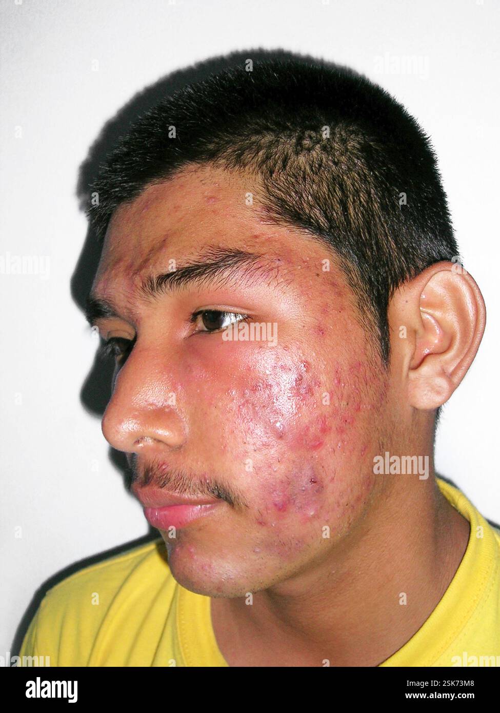 Nodulocystic acne on the face of a 16 year old boy that is improving ...
