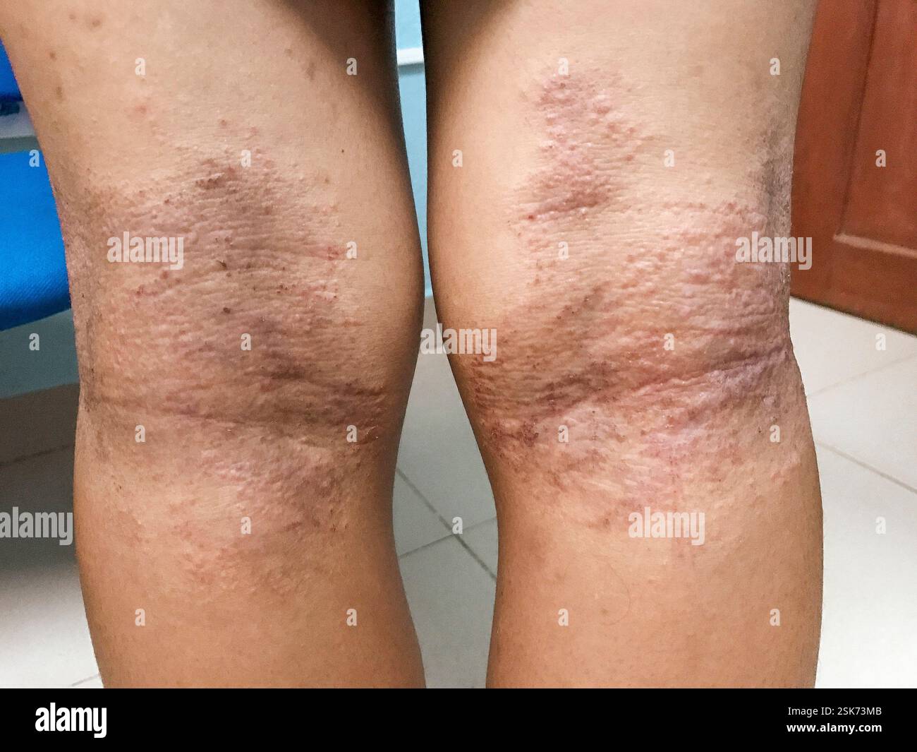 Atopic dermatitis on a 12 year old Hispanic female patient's legs ...