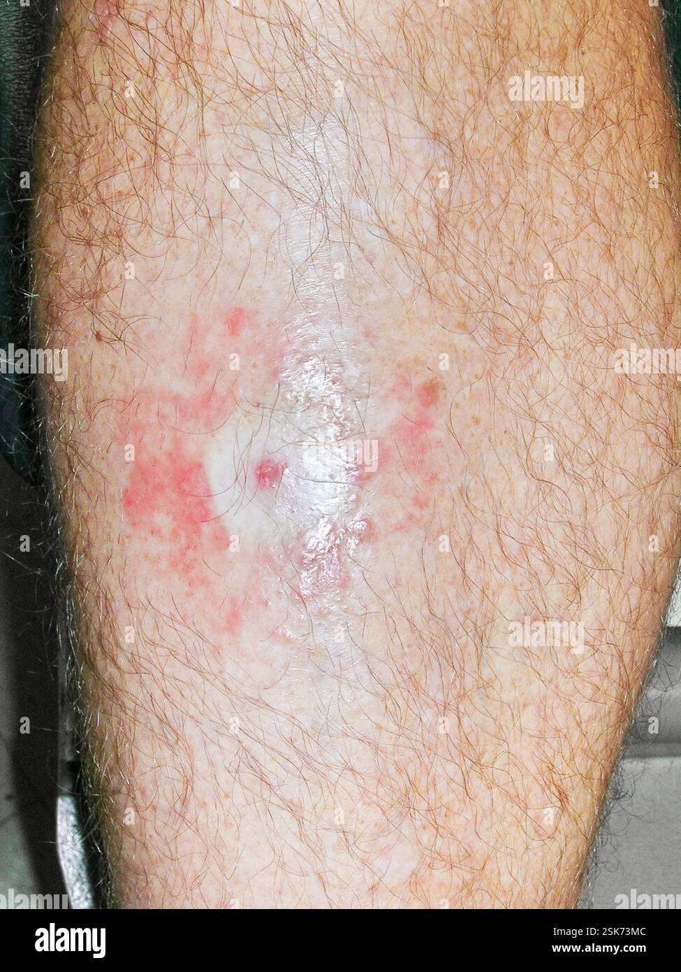 Nodular basal cell carcinoma (BCC), or rodent ulcer, on a 60 year old ...