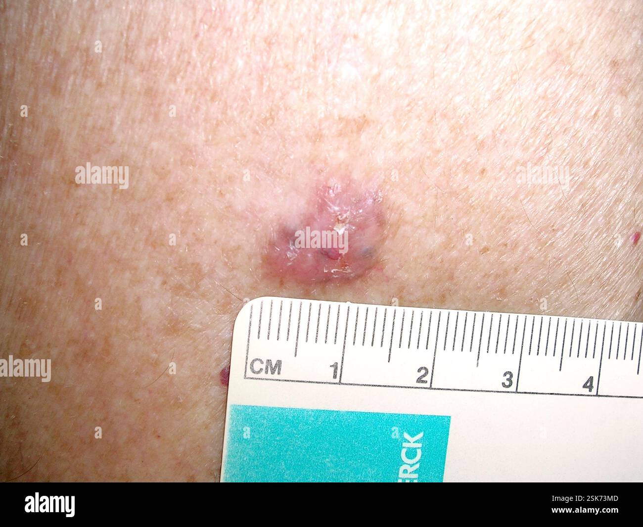 Basal cell carcinoma (BCC), or rodent ulcer, being measured. This is ...
