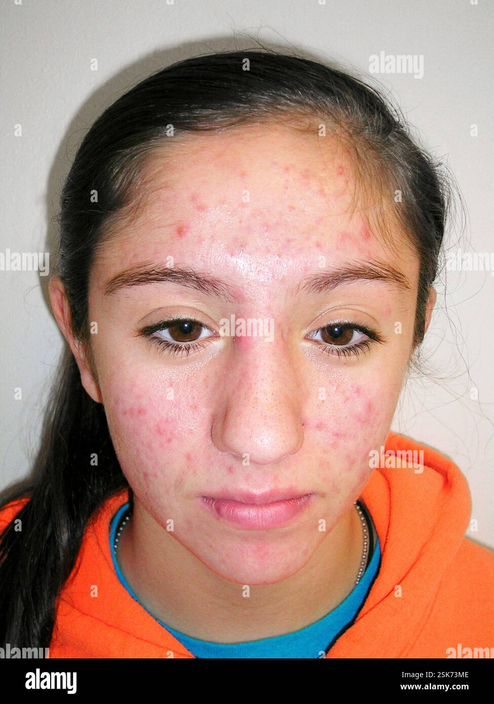 Acne on a female patient's face. Acne is a general name given to a skin ...