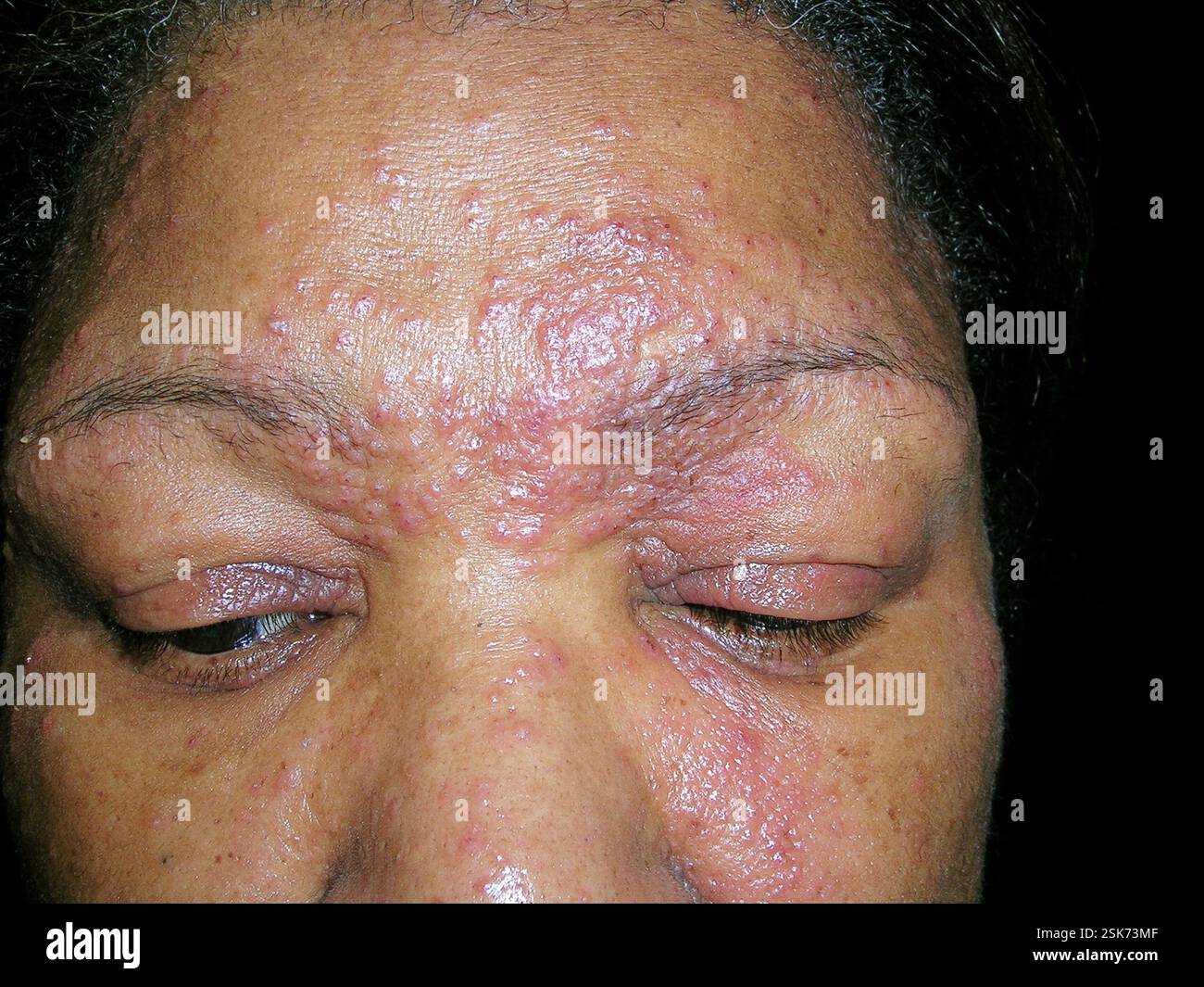 Allergic contact dermatitis on a patient's face caused by eyeliner ...
