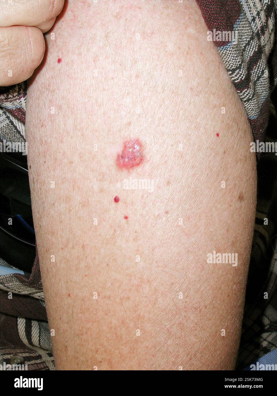Basal cell carcinoma (BCC), or rodent ulcer, on a patient's skin. This ...