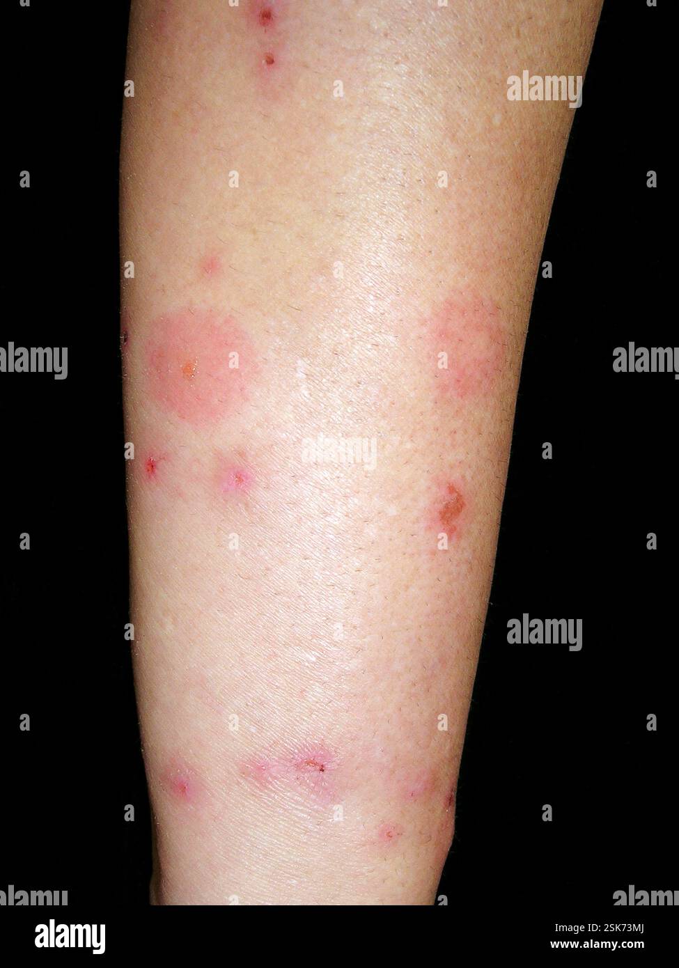 Bed bug bites on a young Hispanic female patient's arm. The common bed ...