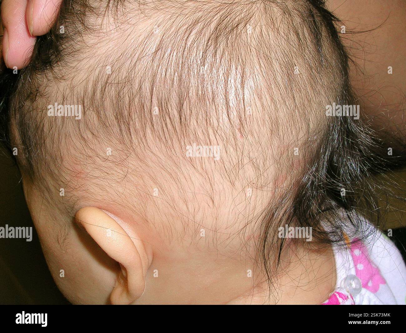 Bald spots that are improving on the head of a baby with alopecia ...