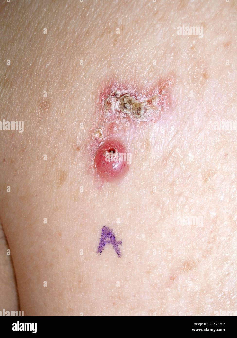 Basal cell carcinoma (BCC), or rodent ulcer, on a male patient's arm ...