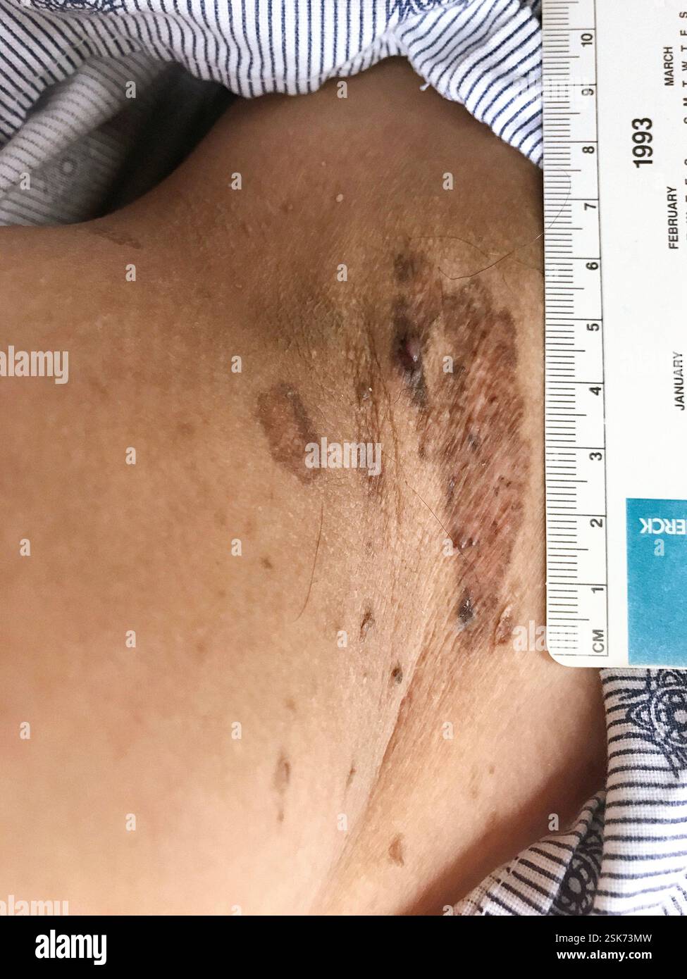 Basal cell carcinoma (BCC), or rodent ulcer, in a patient's armpit ...