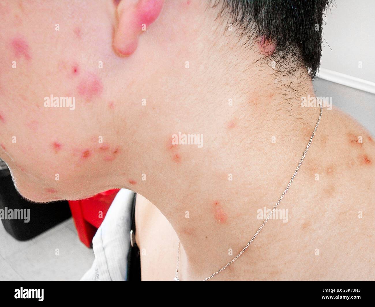Bed bug bites on a young Hispanic female patient's neck and face. The ...