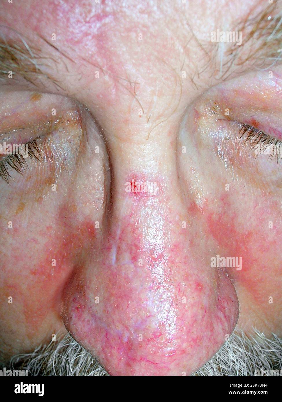 Basal cell carcinoma (BCC), or rodent ulcer, on a patient's nose. This ...