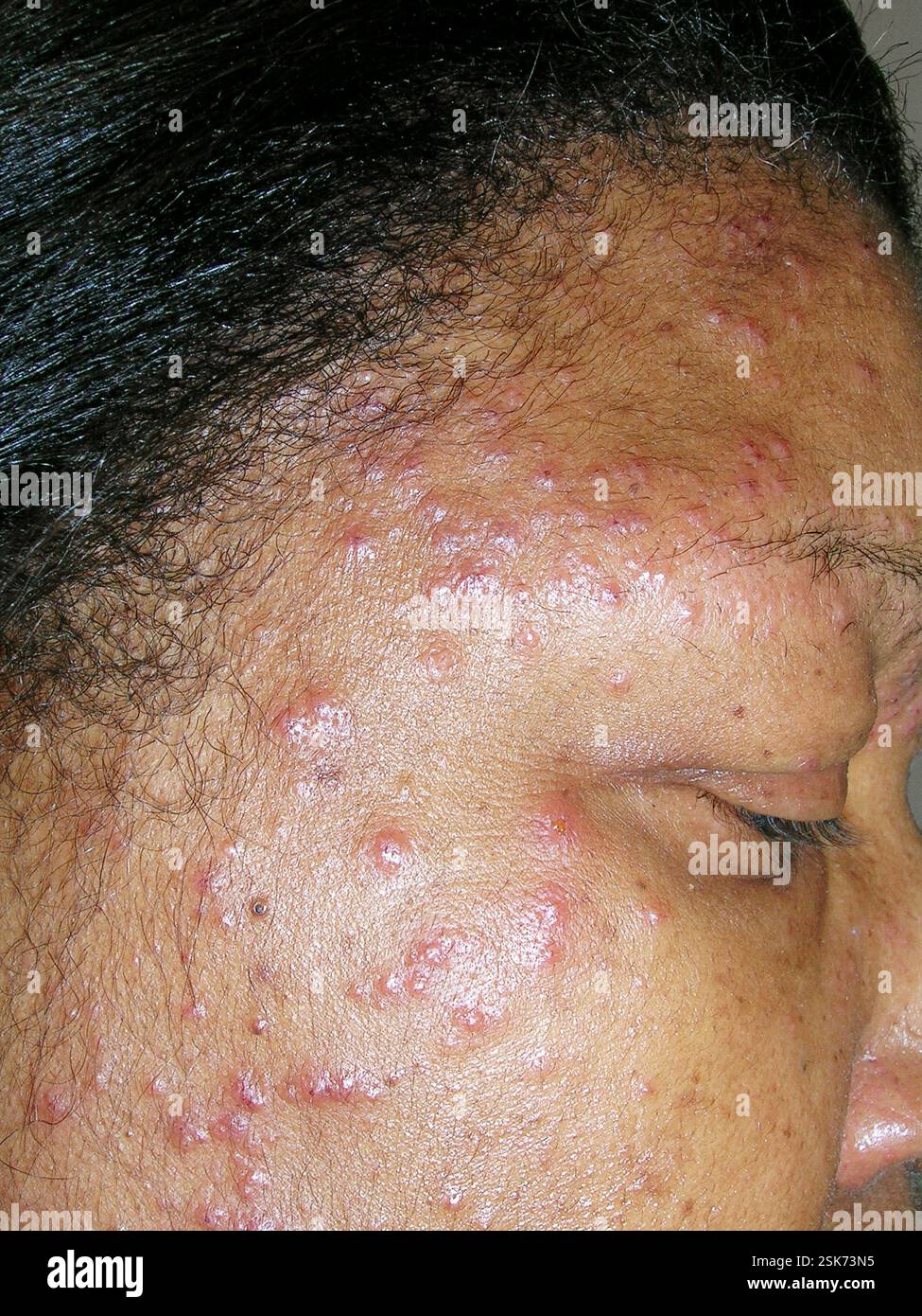 Allergic contact dermatitis on a patient's face caused by eyeliner ...