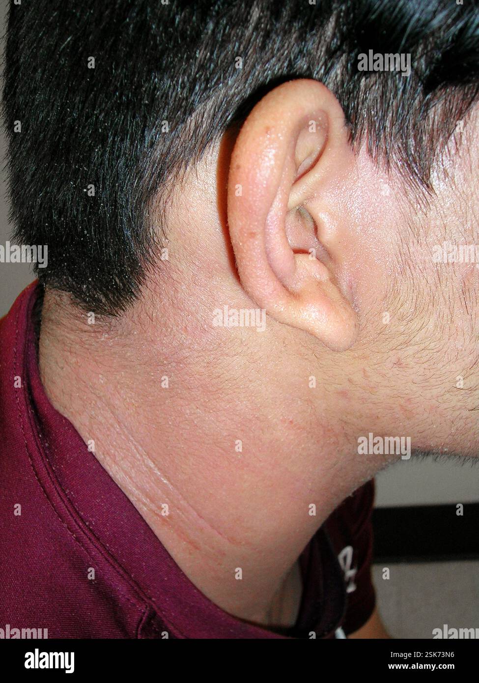 Atopic dermatitis on a boy's neck. Atopic dermatitis, also called ...