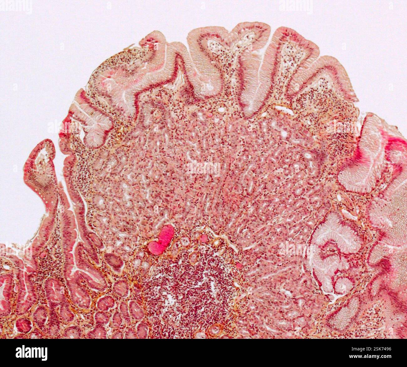 Duodenal Polyp Light Micrograph Of A Section Through A Polyp In The Duodenum Of The Small
