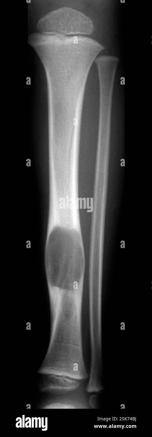 Fibrous dysplasia of the tibia (shin bone), X-ray. This is an extremely ...