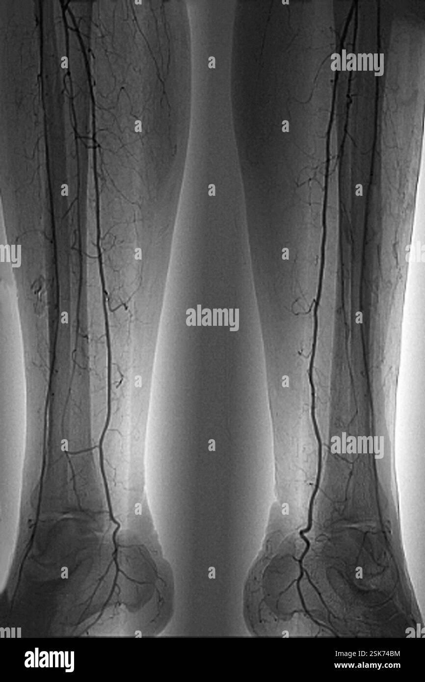 Lower leg anatomy. Angiogram (X-ray) of the lower legs of a 72 year old female patient showing ...