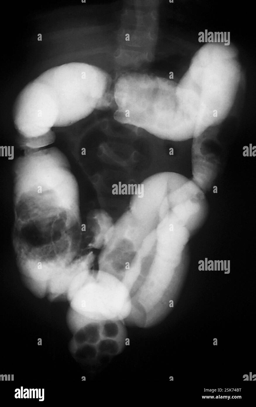 Intussusception of the intestines of a 6 month old, barium enema X-ray ...