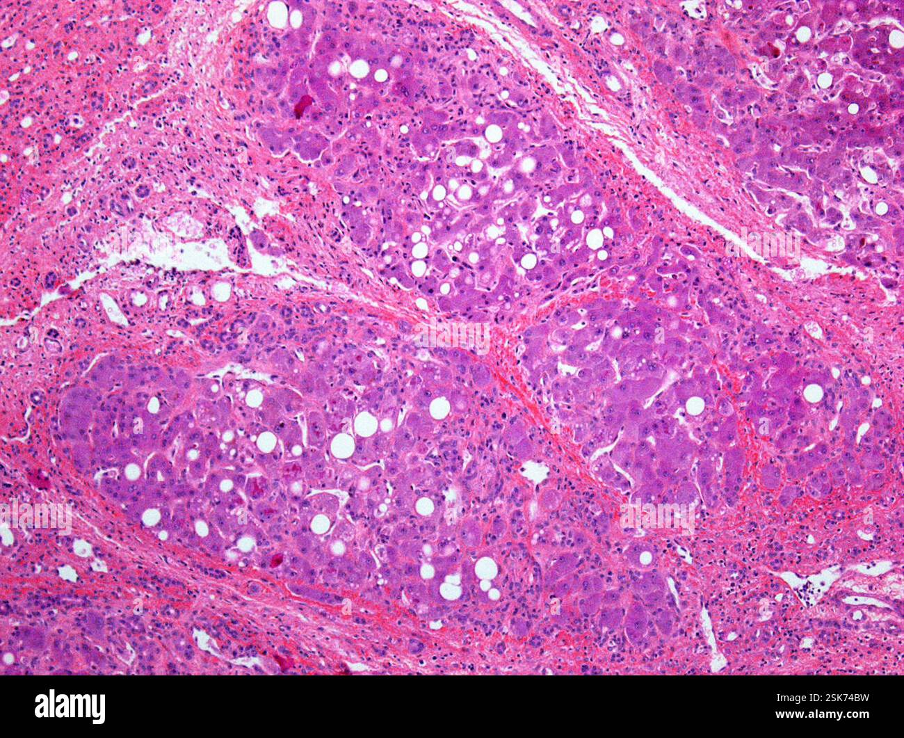 Alcoholic cirrhosis. Light micrograph of tissue from a liver in a case ...