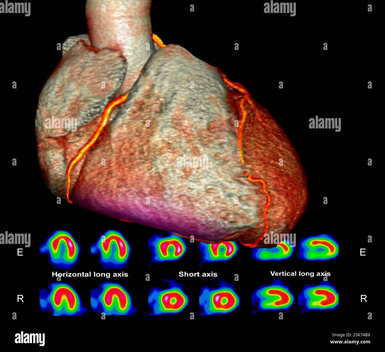 Heart attack. 3D computed tomography (CT) scan (top) and myocardial ...