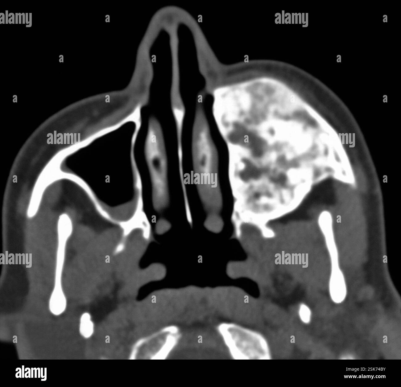 Fibrous dysplasia of the left maxillary sinus of the skull, computed ...