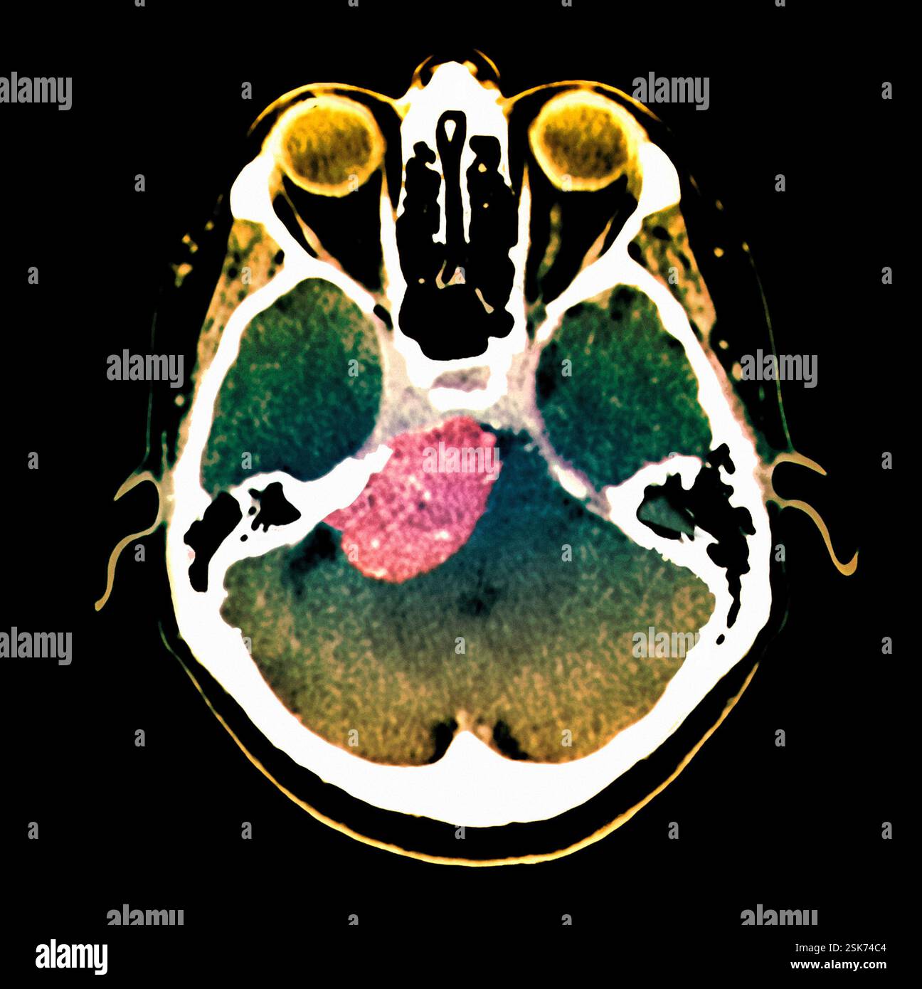 Benign brain tumour. Coloured computed tomography (CT) scan of the brain of a 48 year old male ...
