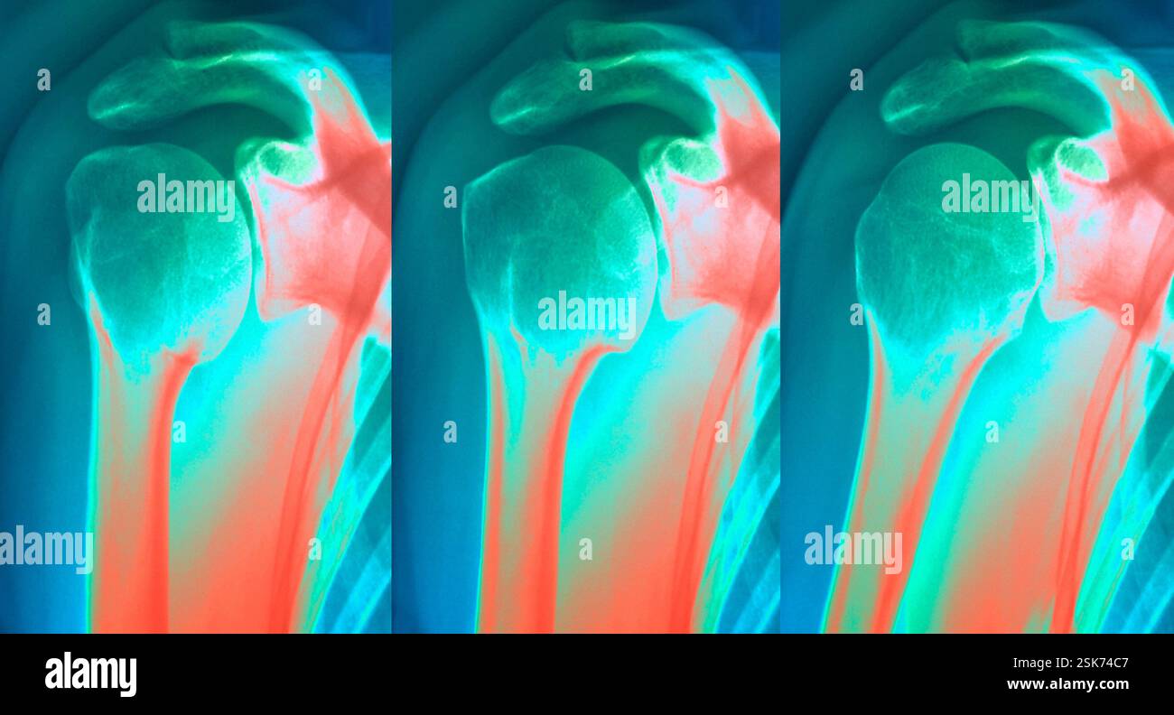 Normal shoulder joint, coloured X-rays Stock Photo - Alamy