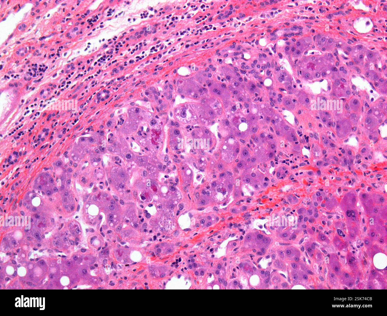 Alcoholic cirrhosis. Light micrograph of tissue from a liver in a case ...