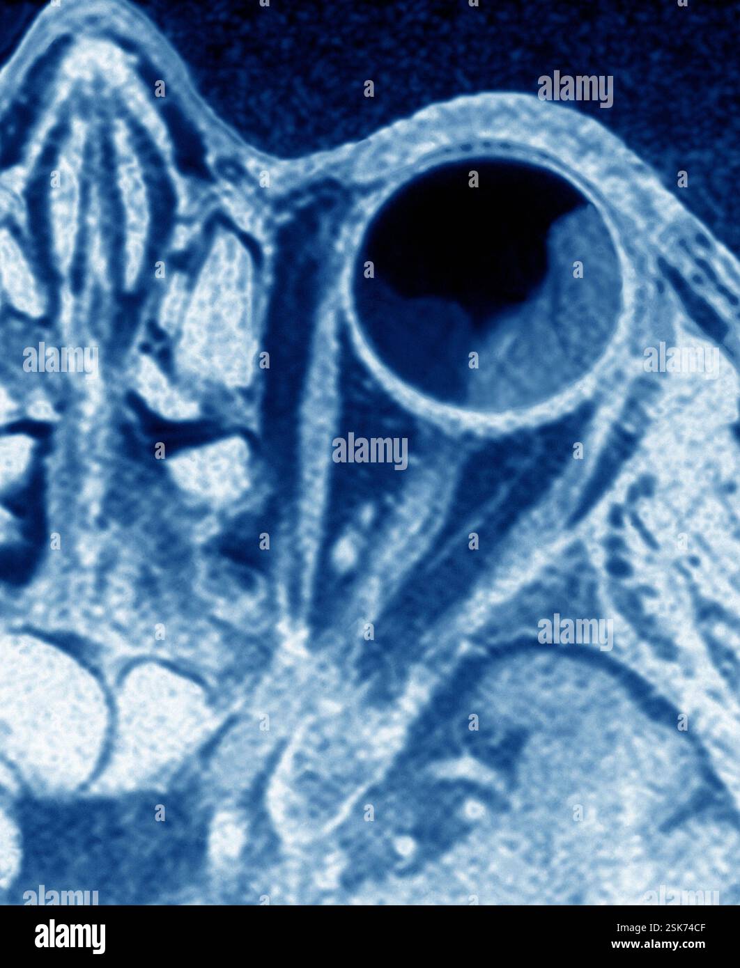 Eye cancer. Coloured magnetic resonance imaging (MRI) scan of the left ...