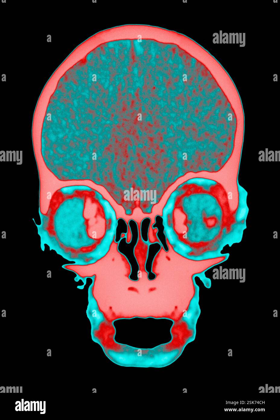 Eye cancer. Coloured computed tomography (CT) scan of the skull of a 9 ...