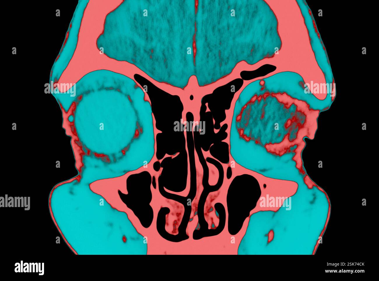 Eye cancer. Coloured computed tomography (CT) scan of the head of a 62 ...