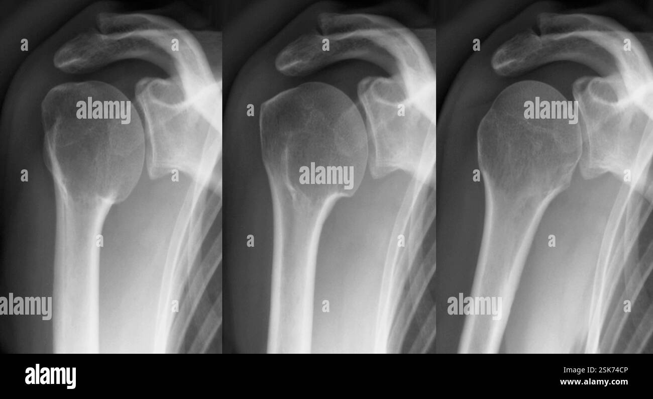 Normal shoulder joint, X-rays Stock Photo - Alamy