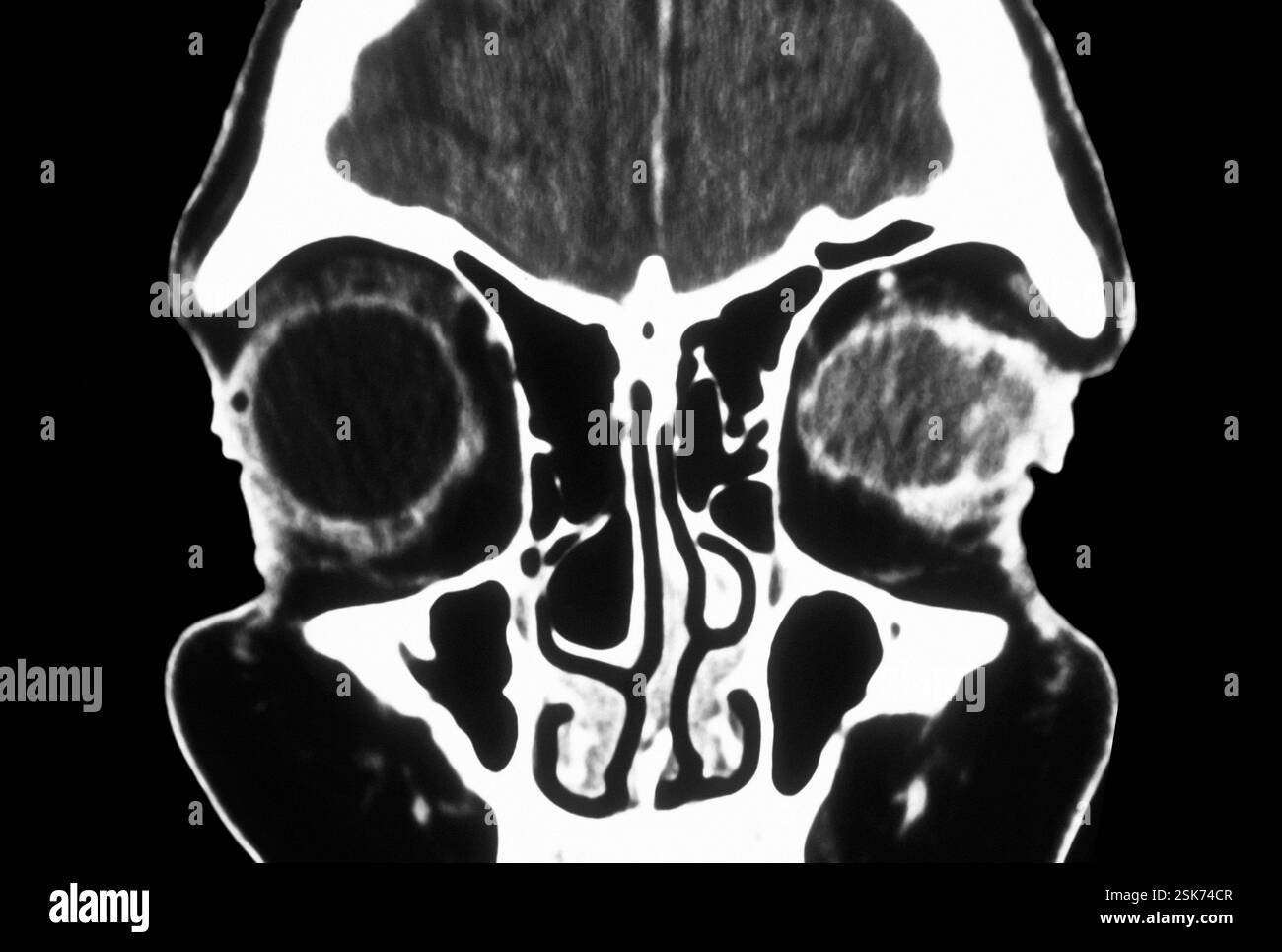 Eye cancer. Computed tomography (CT) scan of the head of a 62 year old ...