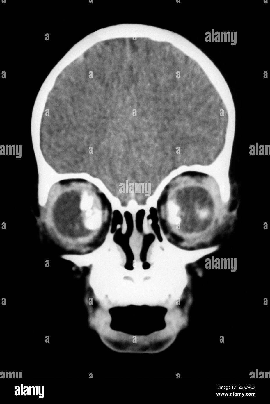 Eye cancer. Computed tomography (CT) scan of the skull of a 9 year old ...