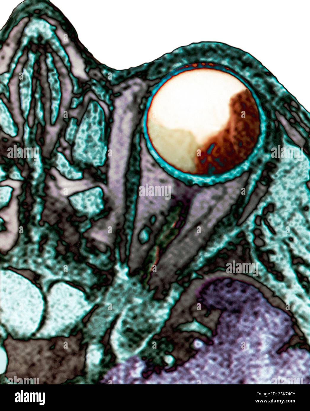 Eye cancer. Coloured magnetic resonance imaging (MRI) scan of the left ...