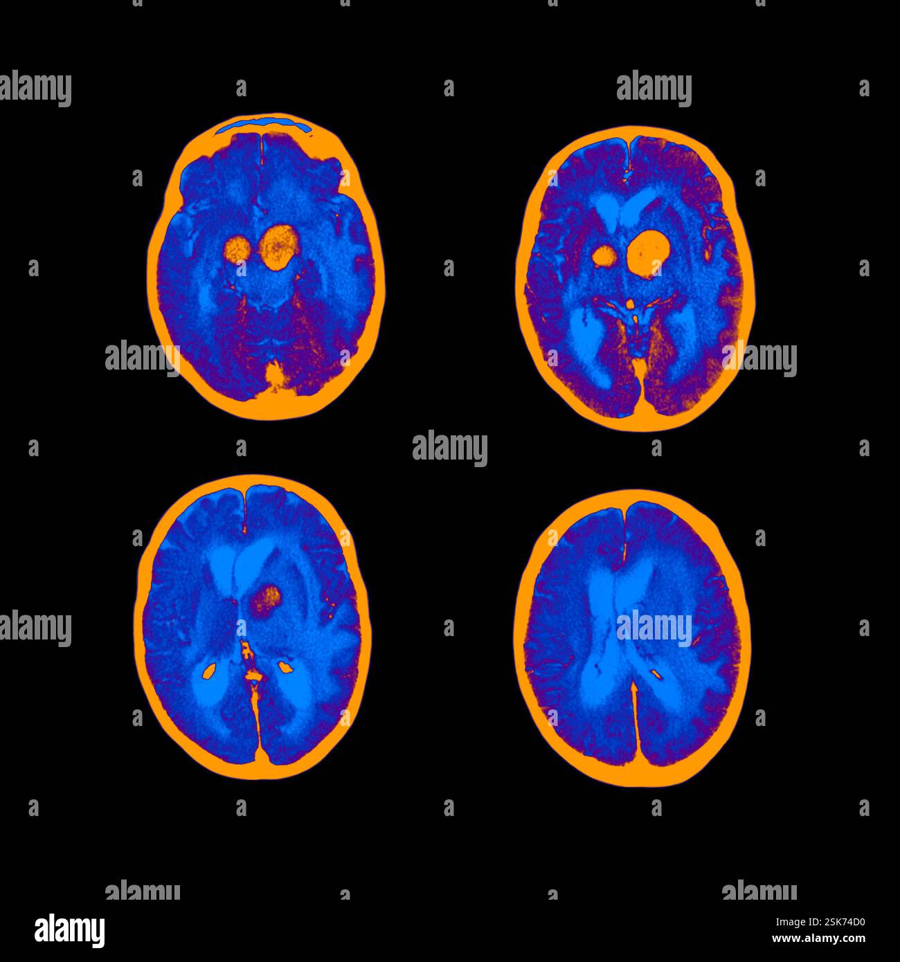Brain cancer. Coloured computed tomography (CT) scans of the brain of a ...
