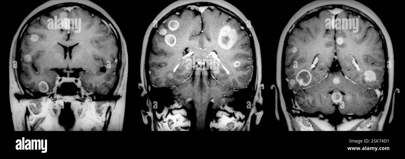 Secondary brain cancer. Magnetic resonance imaging (MRI) scans of brain of a 42 year old patient ...