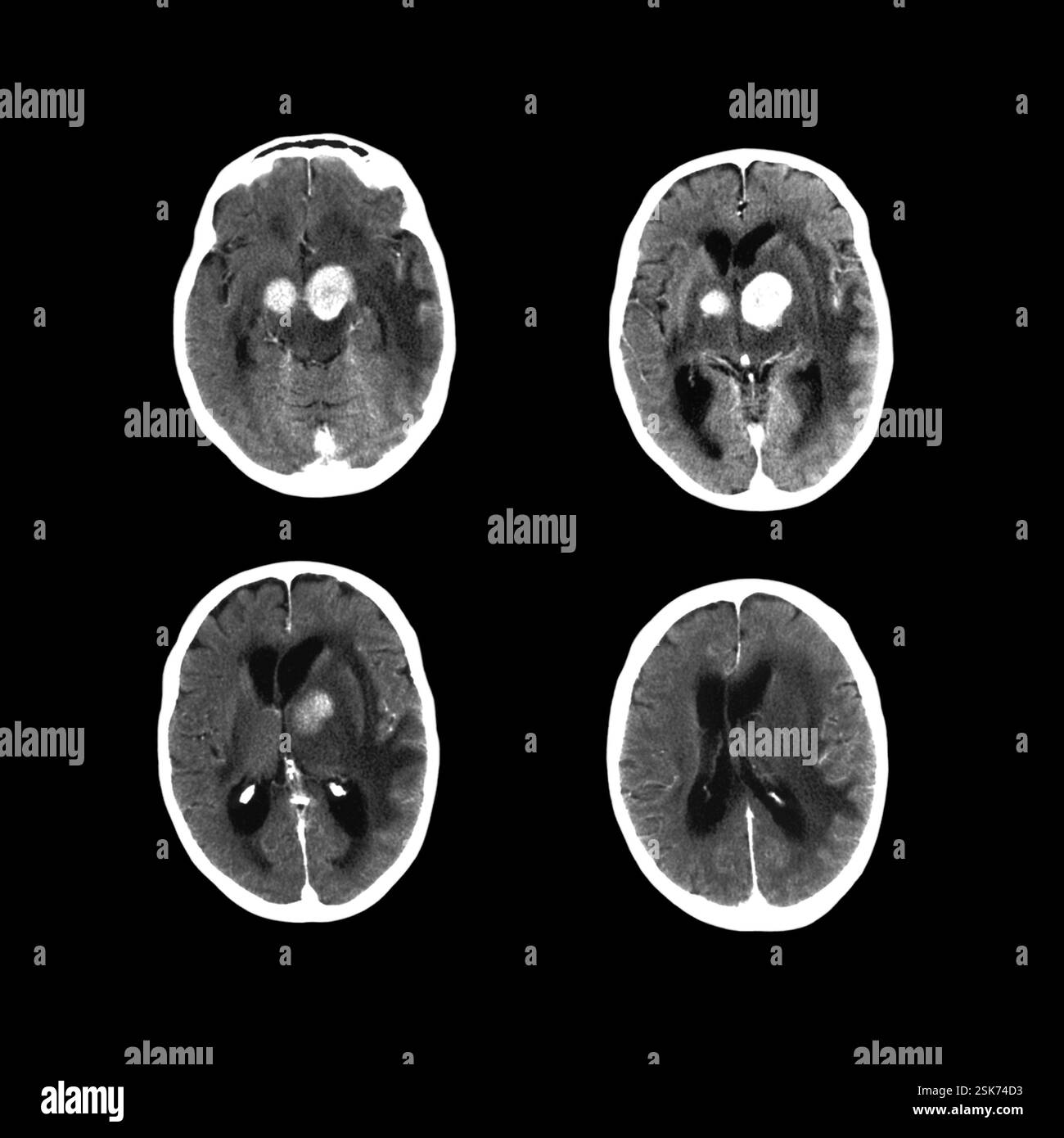 Brain cancer. Computed tomography (CT) scans of the brain of a 62 year ...
