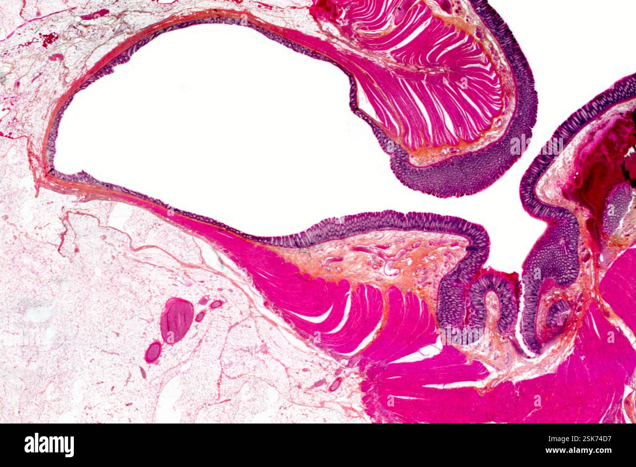 Diverticulum, light micrograph. A diverticulum is a small pouch-like ...