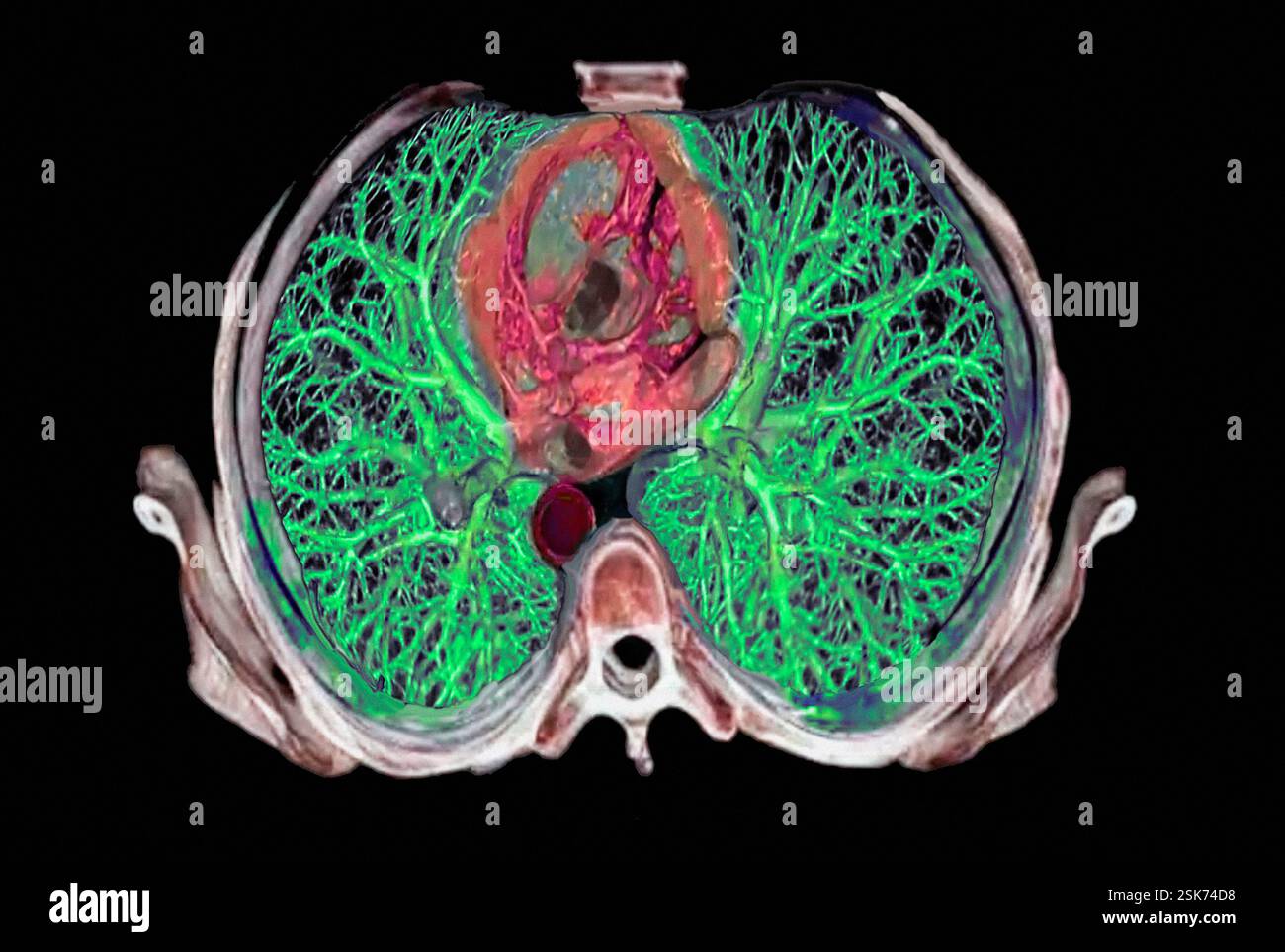 Healthy lungs. Coloured 3D computed tomography (CT) scan of the chest of a 47 year old male ...