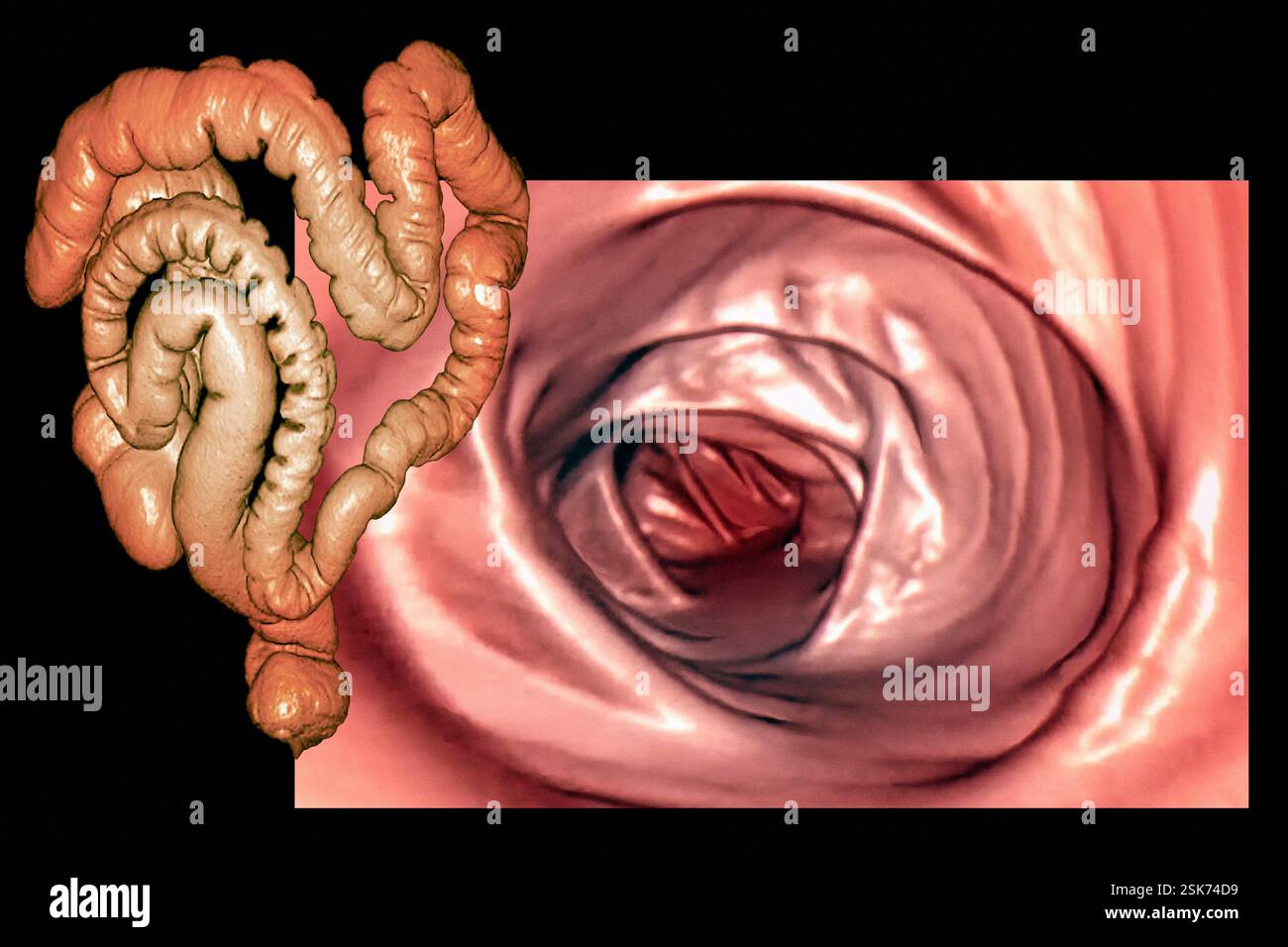 Normal colon. Coloured frontal 3D computed tomography (CT) scan (left ...