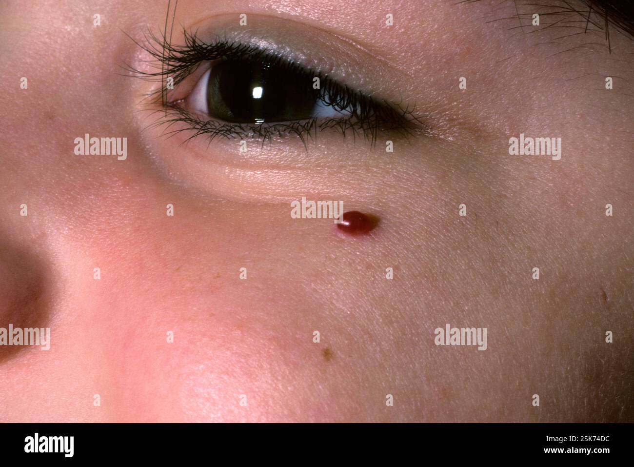 Pyogenic granuloma on a child's cheek. A pyogenic granuloma is neither ...