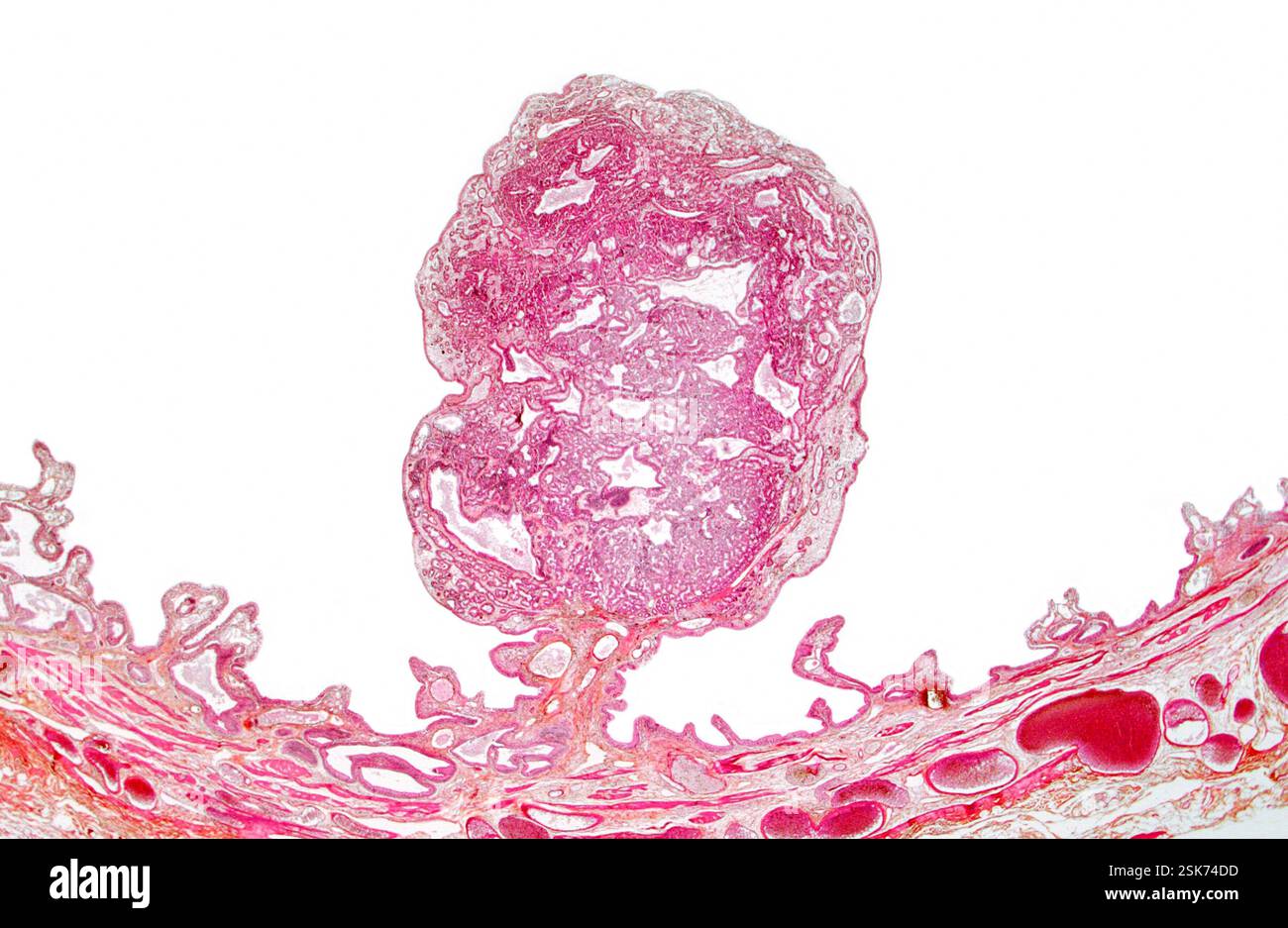 Polyp of the gallbladder, light micrograph. Polyps are small growths ...