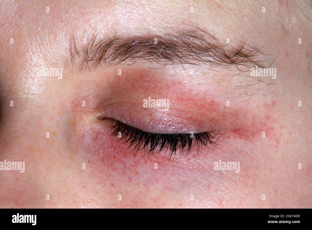 Cutaneous amyloidosis on the eyelid. This is a disease where the ...