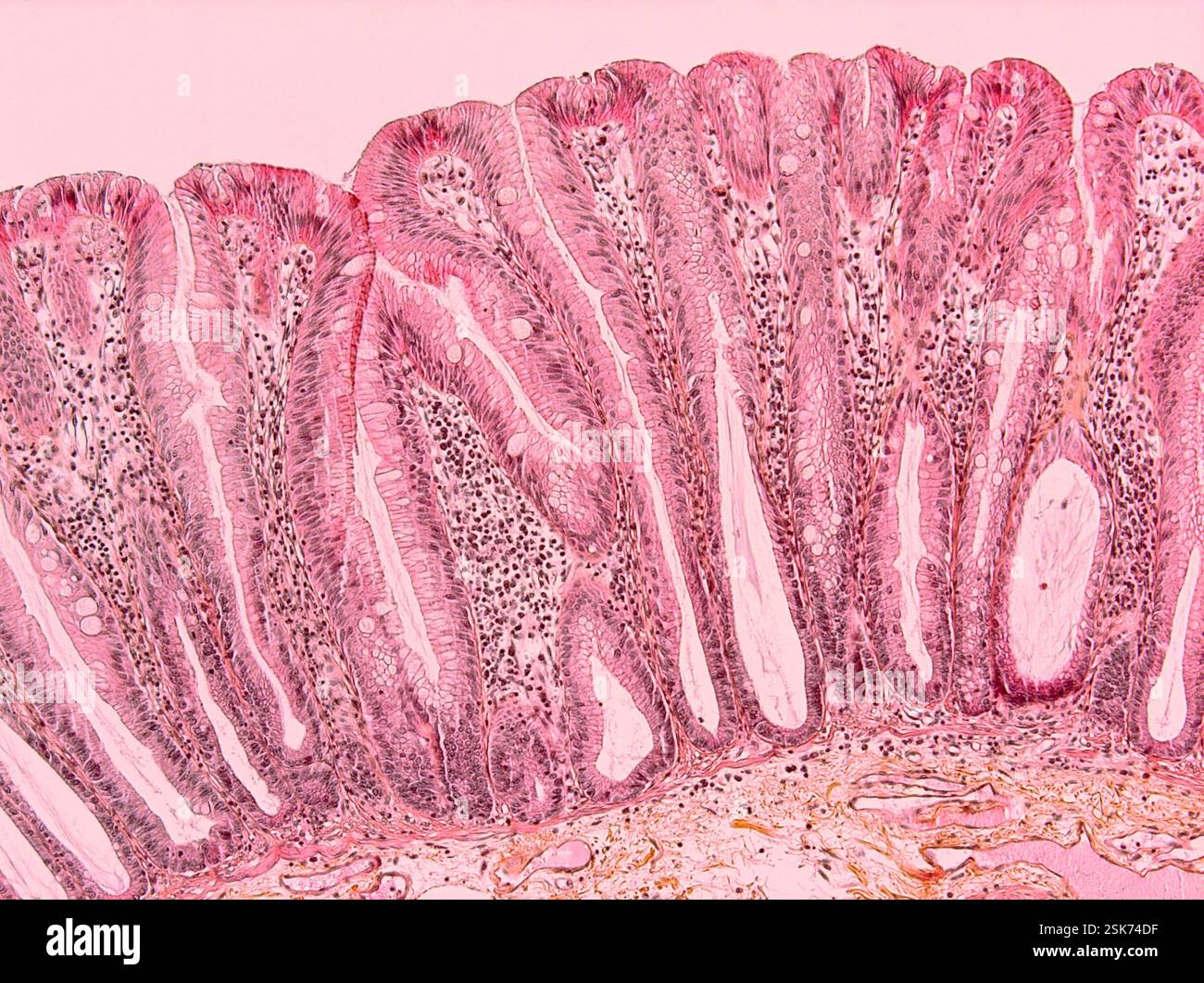 Colon cancer. Light micrograph of a section through an adenocarcinoma ...